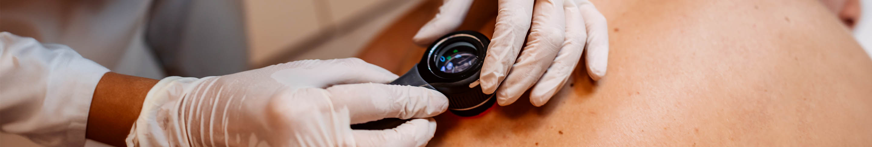 Cancro della pelle: sintomi e trattamento | Redcare